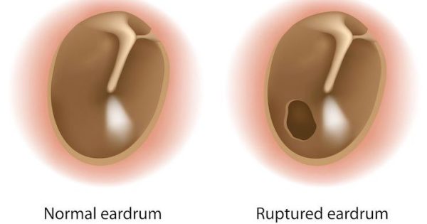 Tympanic Membrane Perforation: So you have a ruptured ear drum, now ...